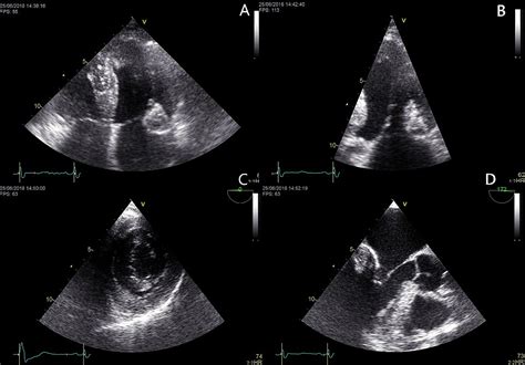 Caseous Calcification Of The Mitral Annulus Presenting As Recurrent