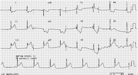 Old Inferior Myocardial Infarction Ecg