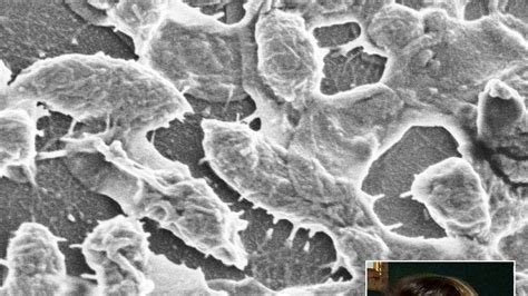 necrotizing fasciitis life after flesh eating bacteria