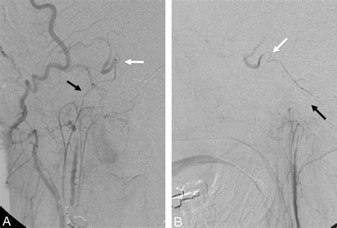 Right Ascending Pharyngeal Occipital Angiogram In Anteroposterior A