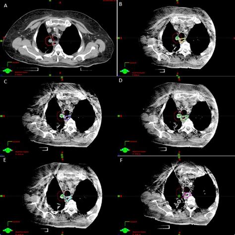 A Treatment Planning Computed Tomography Ct For Patient 1 With The