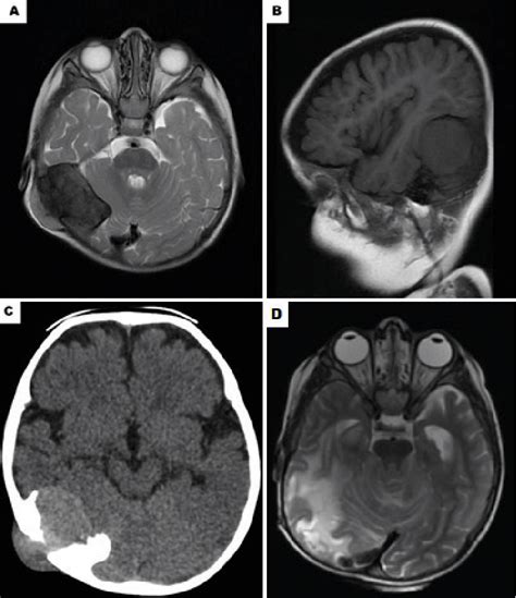 Figure 1 From The Recurrence Of The Melanotic Neuroectodermal Tumour Of