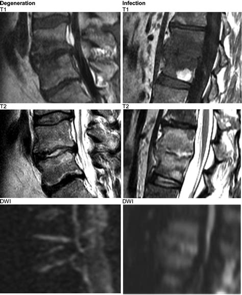 Diffusion Weighted Mri “claw Sign” Improves Differentiation Of