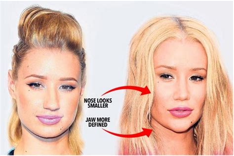 Iggy Azalea Nose Job