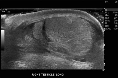 Testicular Rupture Ultrasound