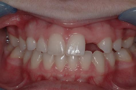 After Implant Placement Scarsdale Ny • Nyomis Oral Surgery