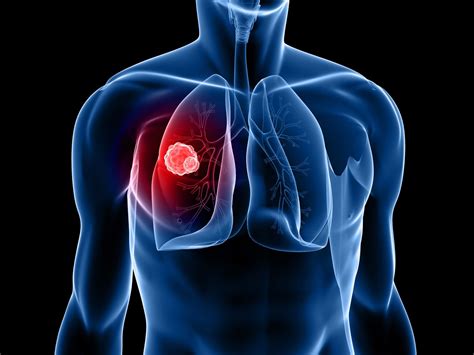 Ct Lung Cancer Screening Albuquerque Diagnostic Imaging New Mexico