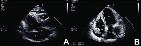 A Echocardiography Showing A Dilated Cs And Pericardial Effusion In