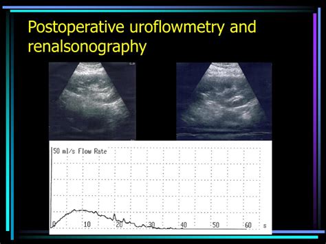 Ppt Bladder Outlet Obstruction In Women Powerpoint Presentation Free