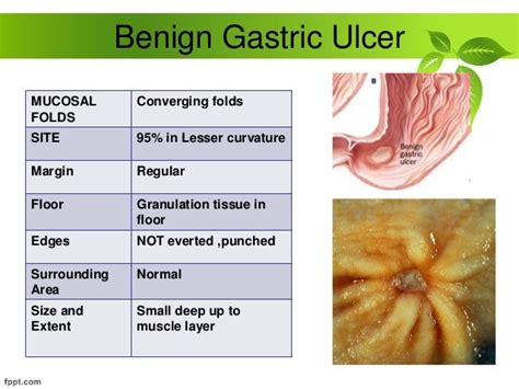 Peptic Ulcer