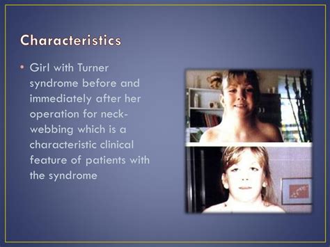 Ppt Turner Syndrome Powerpoint Presentation Free Download Id 2600553