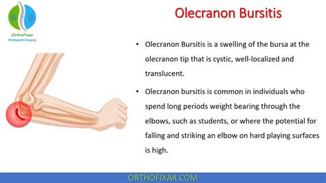 Olecranon Bursitis Symptoms And Treatment Orthofixar 2024