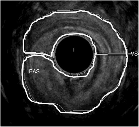Female Anal Canal Low Anal Canal Region Of Interest Outer Structures