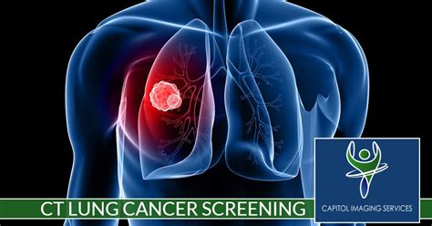 Lung Cancer Screening Capitol Imaging Services