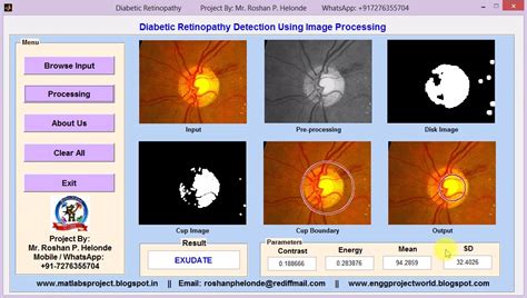 matlab code diabetic retinopathy detection using image processing full