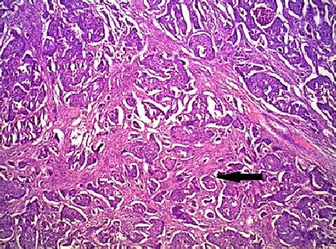 Cureus Correlation Of Tumor Budding With Known Clinicopathological