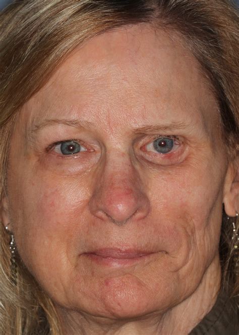 Facial Fat Transfer 08 Amadi Aesthetics Plastic Surgery And Med Spa