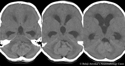 Fourth Ventricle Mri