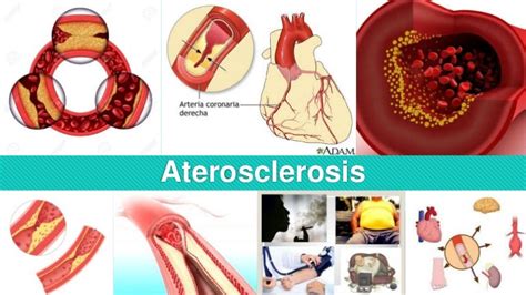 Aterosclerosis Diagnóstico Y Tratamiento