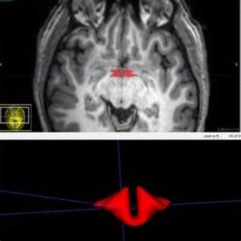 birth control the pill contraceptive shrinks brain lowers sex drive