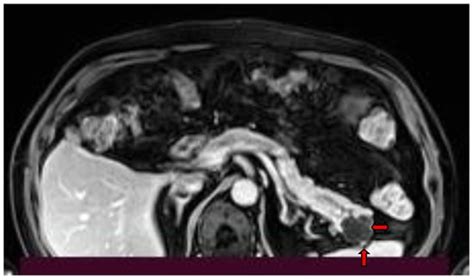 Diagnostics Free Full Text Intraductal Papillary Mucinous Neoplasm