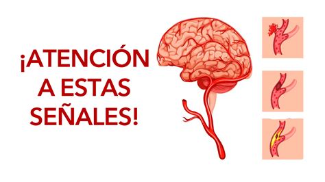 5 Síntomas De Derrame Cerebral Que La Gente Ignora Conocer Salud