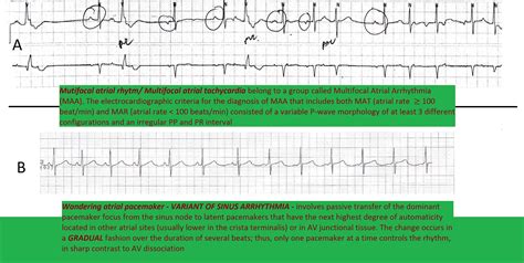 Atrial Rhythm