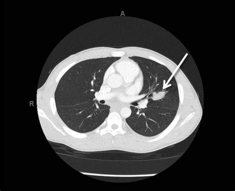 Computed Tomography Chest Scan Showing Multiple Bilateral