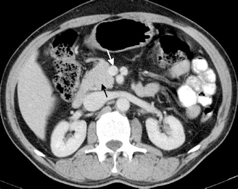 Axial Computed Tomography Section Of The Abdomen At The Level Of The