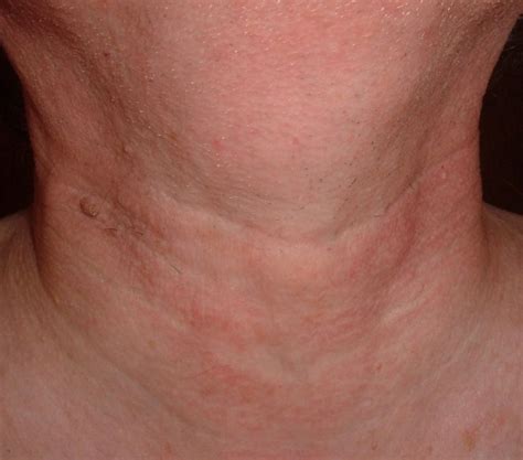 Throat Cancer Early Signs Symptoms Causes And Prognosis Remedies Lore