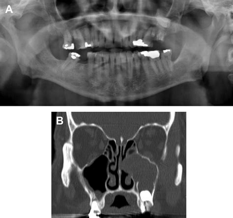 Odontogenic Sinusitis Immunology And Allergy Clinics