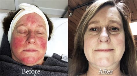 Effective Rosacea Treatment For Redness Pimples Swelling On Face