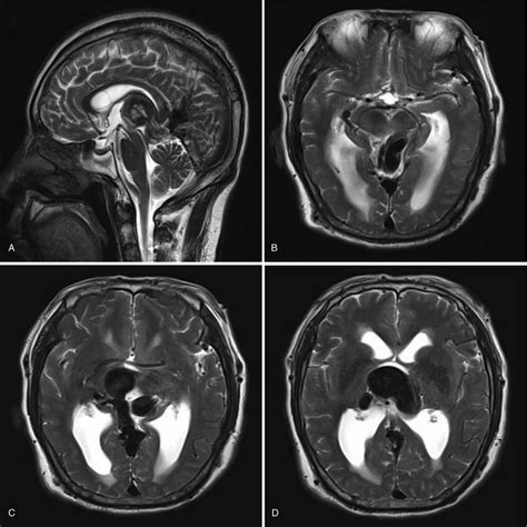 A D Preoperative Magnetic Resonance Imaging Showing Multiple Vascular