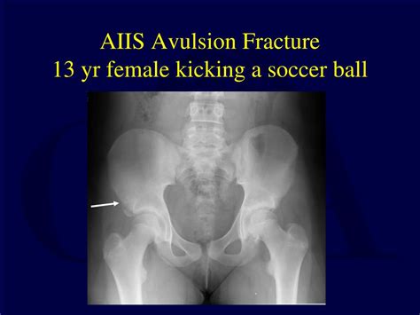 Ppt Fractures Of The Pelvis And Acetabulum In Pediatric Patients
