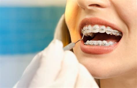 How Do Braces Fix An Overbite Ogara Gilbert Silvaroli Orthodontics