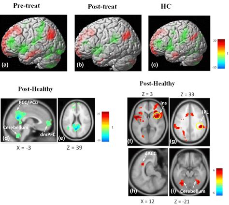 Pcc‐seeded Fc Patterns In The Sciatica And Healthy Groups Dmn Of The