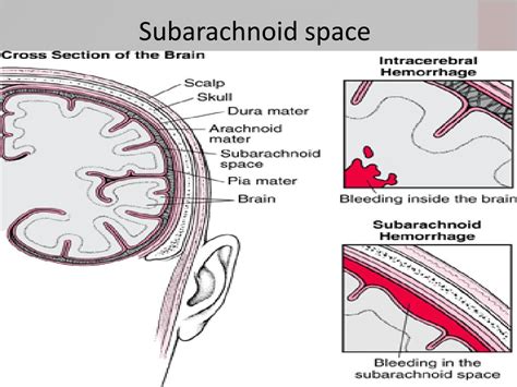 Ppt Title “subarachnoid Haemorrhage” Powerpoint Presentation Free