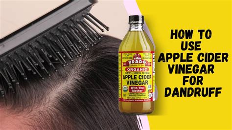 How To Use Apple Cider Vinegar For Dandruff Dandruff Cure Youtube