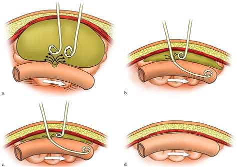 Abscess Fistula Complexes A Systematic Approach For Percutaneous