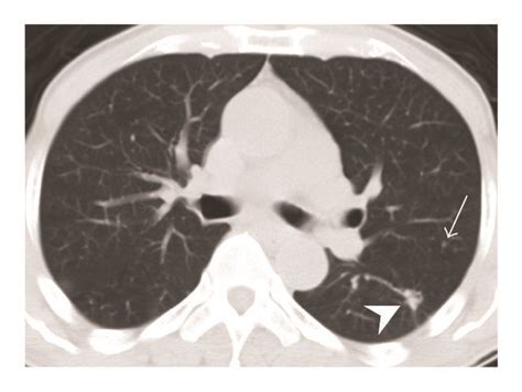 Axial Chest Computed Tomography Scan At Subcarinal Level Demonstrates A