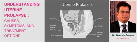 Understanding Uterine Prolapse Causes Symptoms And Treatment Options