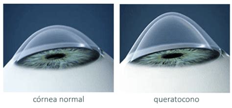 Lentes De Contacto Esclerales Y Queratocono Lentes Esclerales