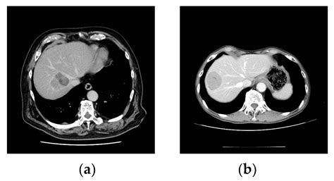 Cancers Free Full Text Safety And Feasibility Of Laparoscopic