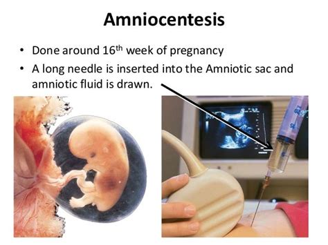 Infections In Pregnancy Foetus And Neonates