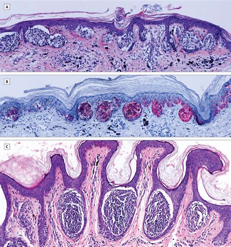 nested melanoma a newly defined entity geriatrics jama dermatology