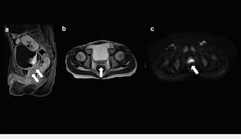 Magnetic Resonance Imaging A Contrast Enhanced T1 Weighted Image