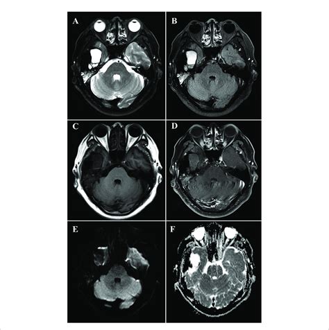 Magnetic Resonance Imaging Mri Of A 48 Year Old Man With Diffuse