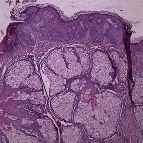 Histopathological Of Skin Biopsy Specimens The Epidermis Is
