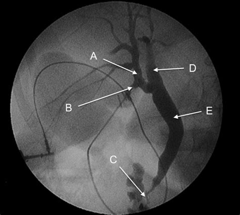 an intraoperative cholangiogram unusual anatomy the bmj