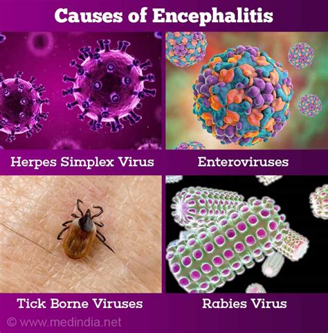 Encephalitis Wikipedia